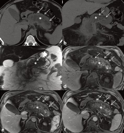 Walled Off Necrosis In 63 Year Old Male 8 Weeks After The Onset Of
