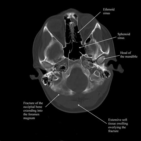 Occipital Condyle Fracture