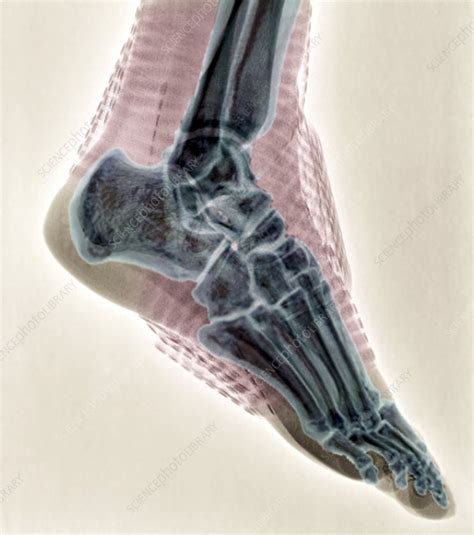 Sprained Ankle Ct Scan Stock Image C0269962 Science Photo Library