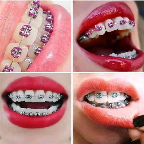Affordable Fashion Braces