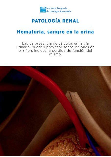 Hematuria Sangre En La Orina