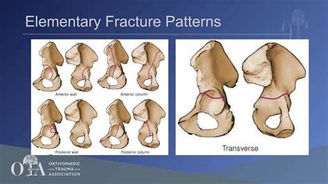 6radiographic Understanding Evaluation And Classification Of Acetabular Fractures Pptx