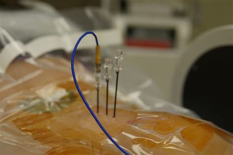 Radiofrequency Ablation St Peters Mo Arch Advanced Pain Management