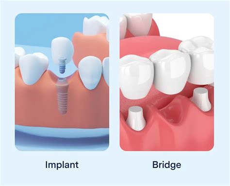 Everything You Need To Know About Partial Dentures Aspen Dental
