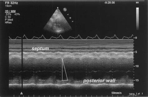 M Mode Short Axis View At Papillary Muscek Kvel Ofthe Left Ventricle Download Scientific