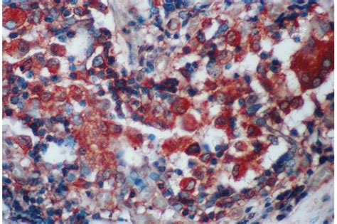 Thioredoxin Expression In A Medullary Carcinoma Of The Thyroid From A