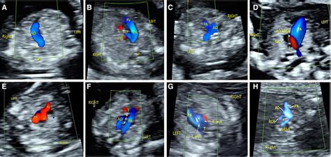 Abnormal Ultrasound Image Pattern Of 3VT Section A Patterns Of