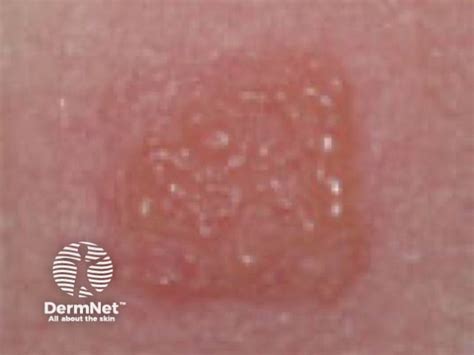 Dermnet® Baseline Series Of Patch Test Allergens