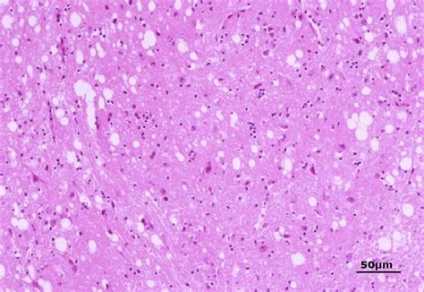 Image Spongiosis In Bovine Sponorm Encephalopathy Msd Veterinary Manual