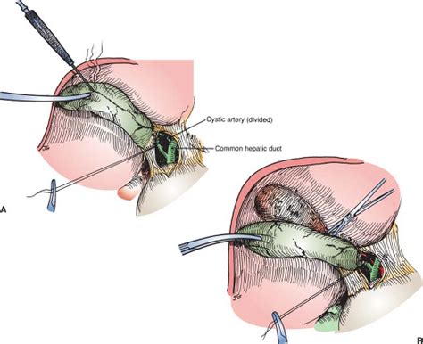 Cystic Duct