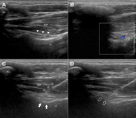 Figure From Does Combining A Suprascapular Nerve Block With An Intra Articular Corticosteroid