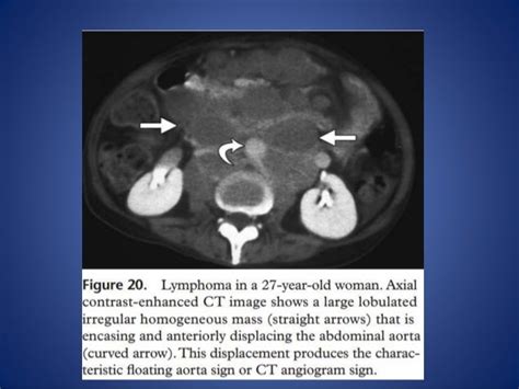 Retroperitoneal Masses Radiology