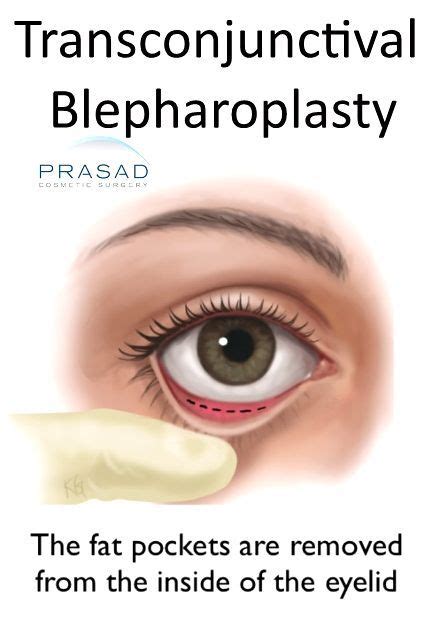 Under Eye Bag Surgery Prasad Cosmetic Surgery New York