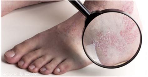 Jedinstveni Recepti Prirodni Lekovi Za Psorijazu