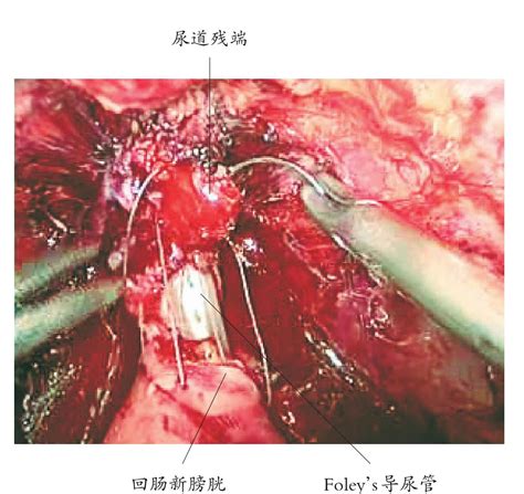一 原位新膀胱术 泌尿科学 医学