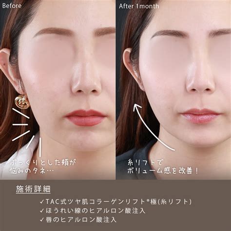 たるみとほうれい線を改善し、美人度アップ｜症例写真・ビフォーアフター｜美容整形･美容外科のtaクリニックグループ