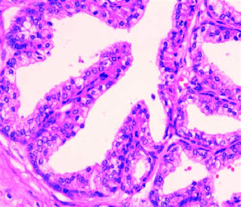 Areas Of Tumor Were Revealed On Pathology Examination Composed Of