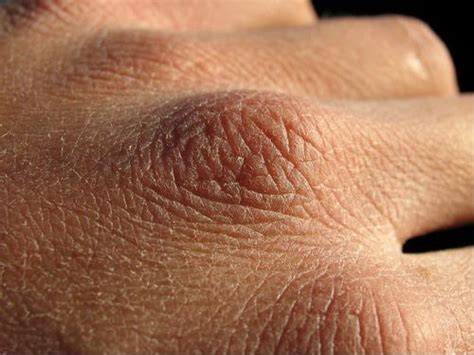 Tips For Treating Dry Skin For Seniors Edgewood Healthcare