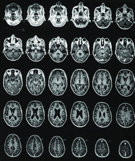 Bilateral Frontoparietal Acute Infarcts And Hyperintensity Over The