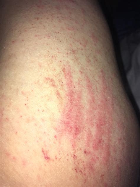 Doc Prescribed Prednisone 25mg For Rash 2x Daily 3 Daysseems Like A