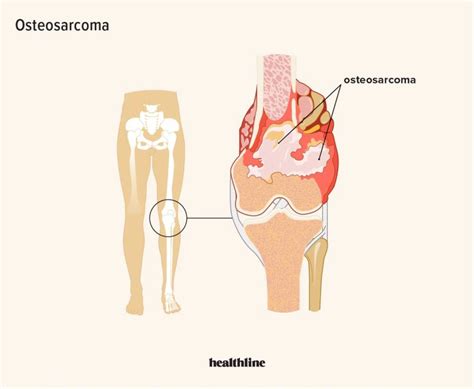 Osteosarcoma Also Called Osteogenic Sarcoma Is The Most Common Type