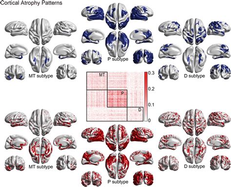 Cortical Atrophy Patterns For Three Ad Subtypes Using The Smc Dataset