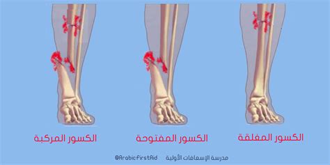 إسعاف حالات الاصابة بالكسور مدرسة الاسعافات الاولية
