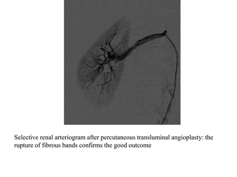 Renal Angiography Pptx Medical Tests Medical Health