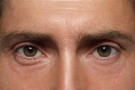Brow Lifts For Men New Jersey Bergen County Englewood Dr David Abramson