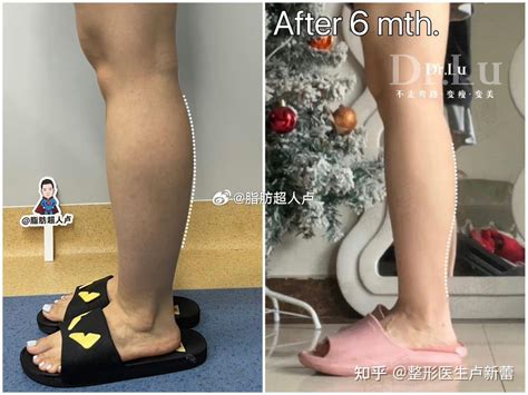 4种不同类型的 小腿粗”，你是哪一种？ 知乎
