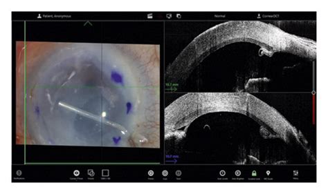 Application Of The Ioct In Dsaek And Dmek Surgery A Confirmation Of Download Scientific