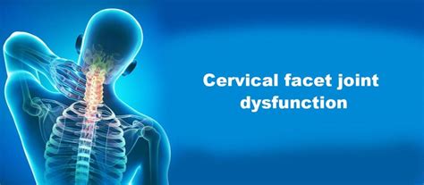 Cervical Facet Joint Dysfunction Mayfair Wellness Clinic