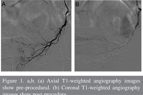 Figure 1 From Clinical Outcomes Of Prostatic Artery Embolization In