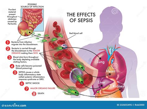 Sepsis Cartoon Vector 42214737