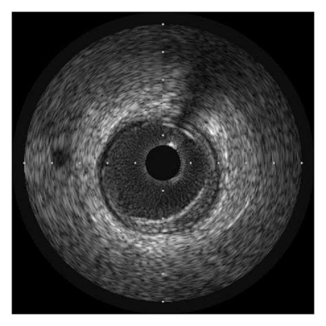 A Shows A Cross Sectional Ivus Image With Visible Calcification And Download Scientific