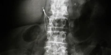 The Health Dangers Of Ivc Filters Farris Riley And Pitt