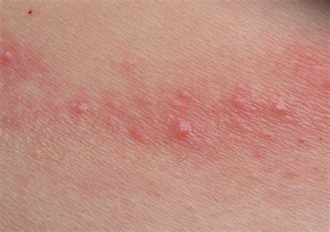 Benzalkonium Chloride A Skin Irritant And Sensitizer In Patients With