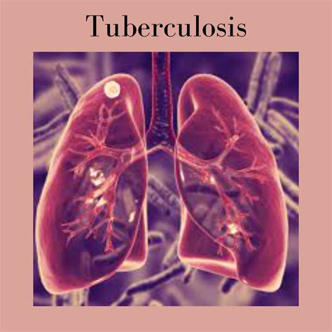 World Tuberculosis Day 2022 Ayurvedography