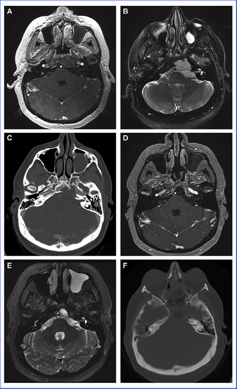 Preoperative Axial T1 Mri With Contrast A Axial T 2 Mri B And Ct Scan