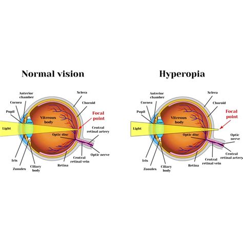 Hyperopia Heyes Opticians