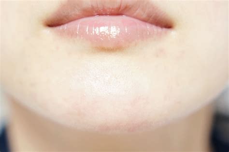 베아로반 턱여드름 모낭염 극복긴글주의사진주의 네이버 블로그