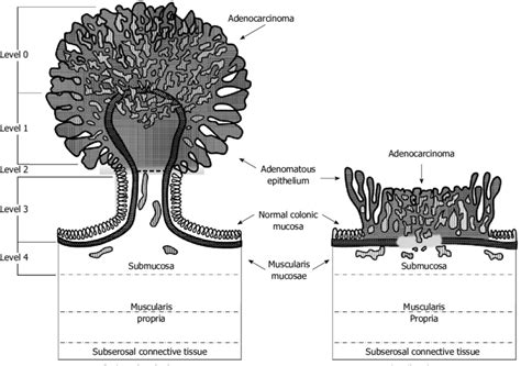 Haggitt Classification Of Pedunculated And Sessile Polyps Reprinted