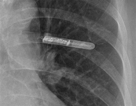 Loop Recorder Specialist Cardiology