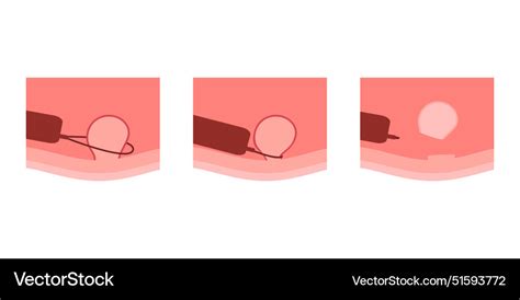 Stage Removal Polyp In Colon Colonoscopy Vector Image