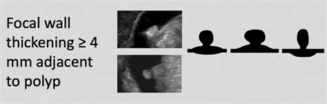 Gallbladder Polyp Management Sru Guidelines And Recommendations