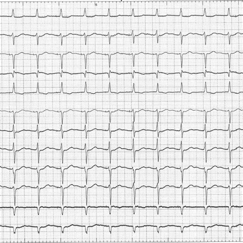 8 His Bundle Pacing Hbp In Ddd Mode In This Patient With