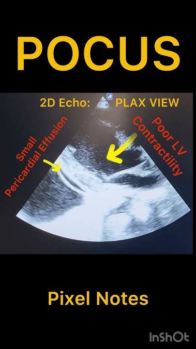 Pocus Plax View 2d Echo Youtube