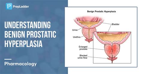 Benign Prostatic Hyperplasia BPH PrepLadder