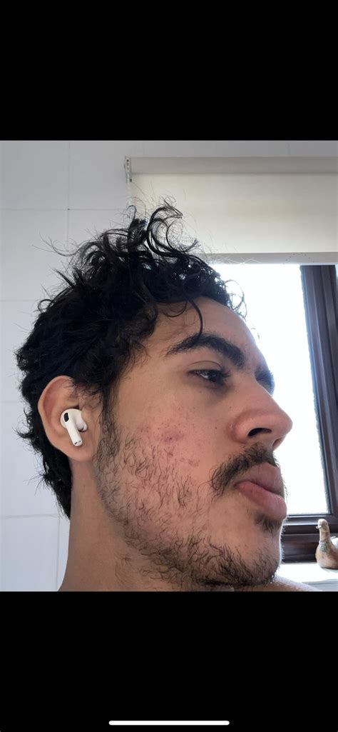 Approaching 7 Months On Minox Before After Rminoxbeards