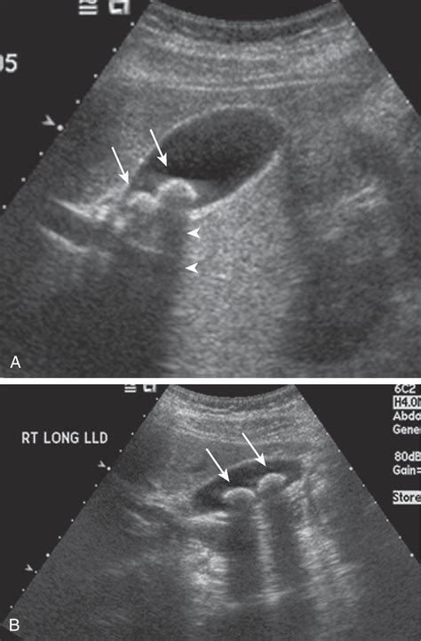 Cholelithiasis Cholecystitis Choledocholithiasis And Hyperplastic